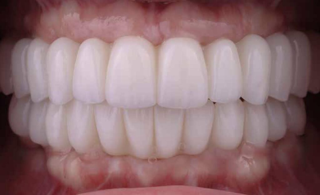 Everything You Need to Know About FP1 Full Arch Implants | Innova ...